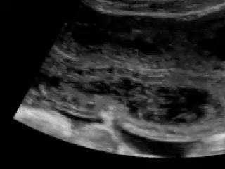 Bowel oedema - Critical Care Sonography