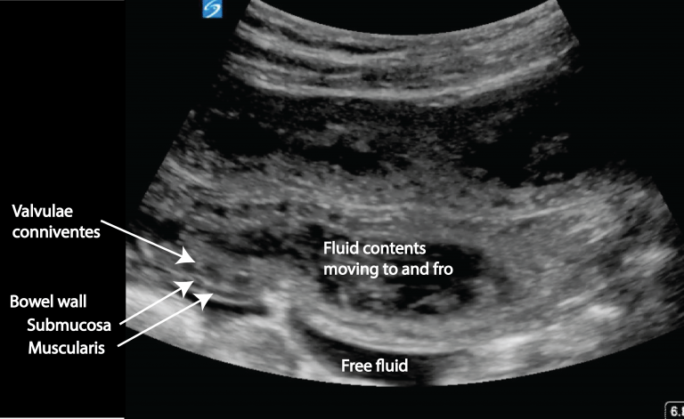 Bowel oedema - Critical Care Sonography