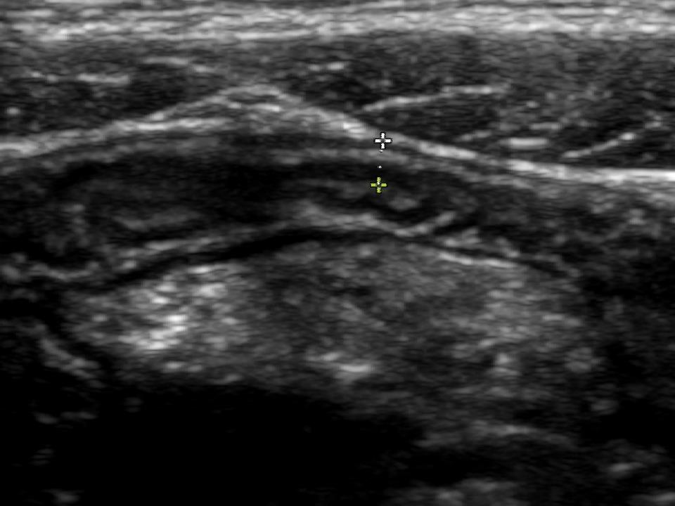 Normal gut ultrasound - Critical Care Sonography