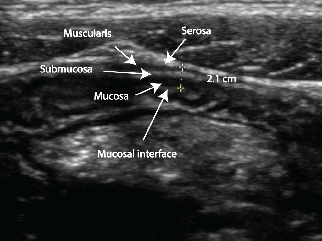 Normal gut ultrasound - Critical Care Sonography