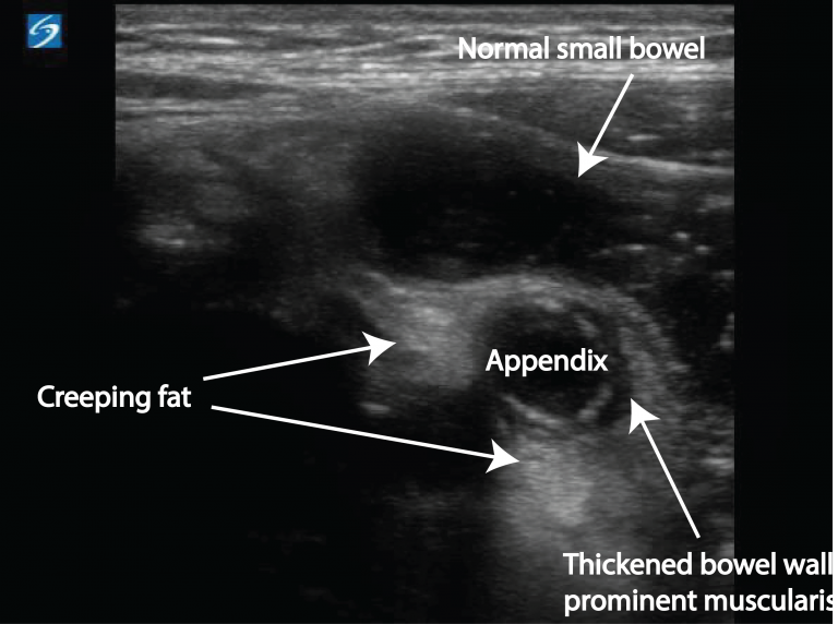 Appendicitis - Critical Care Sonography