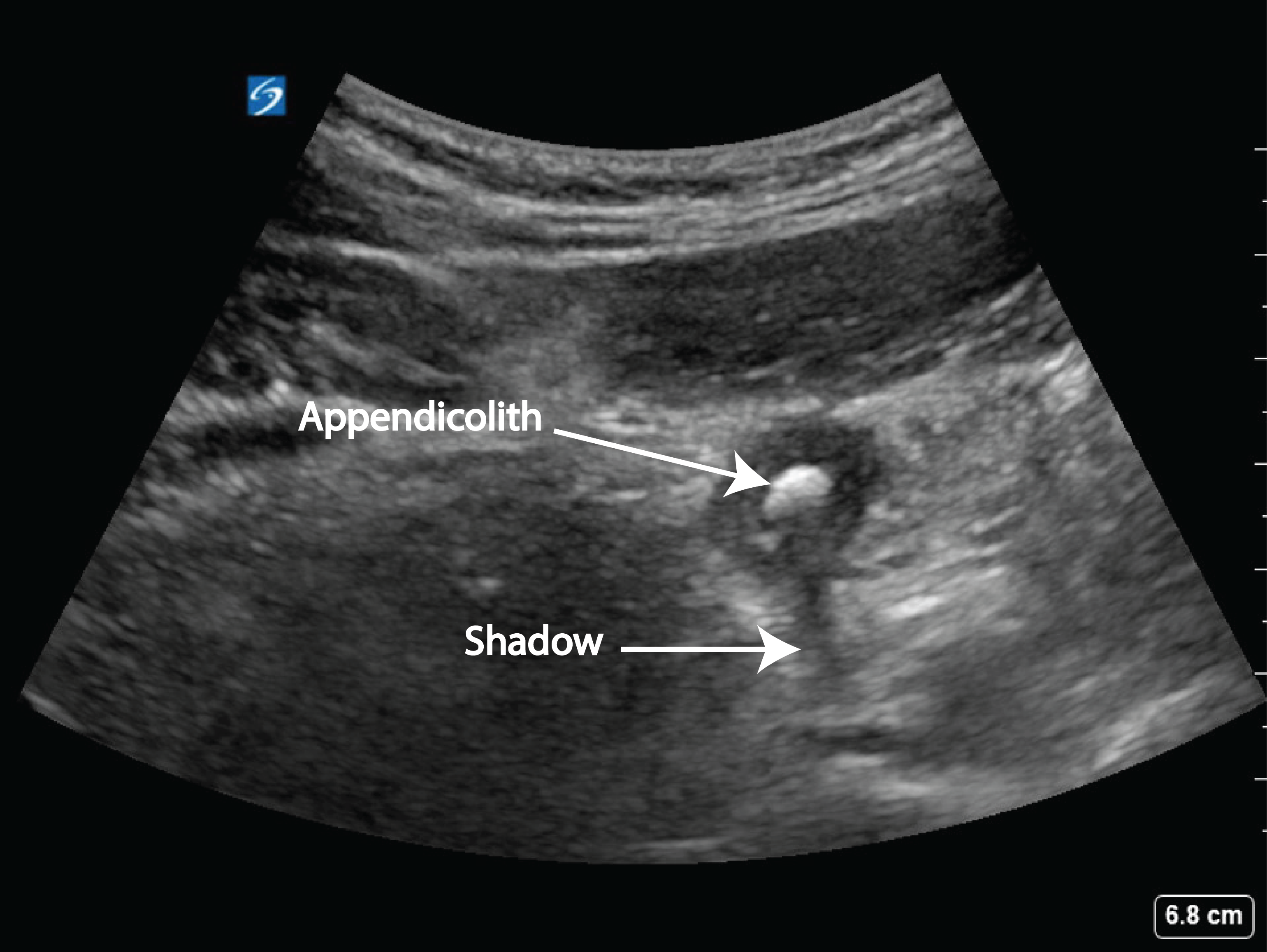 Appendicitis - Critical Care Sonography