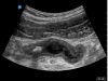 Appendicitis - Critical Care Sonography