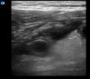Appendicitis - Critical Care Sonography