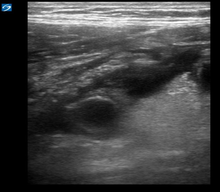 Appendicitis - Critical Care Sonography