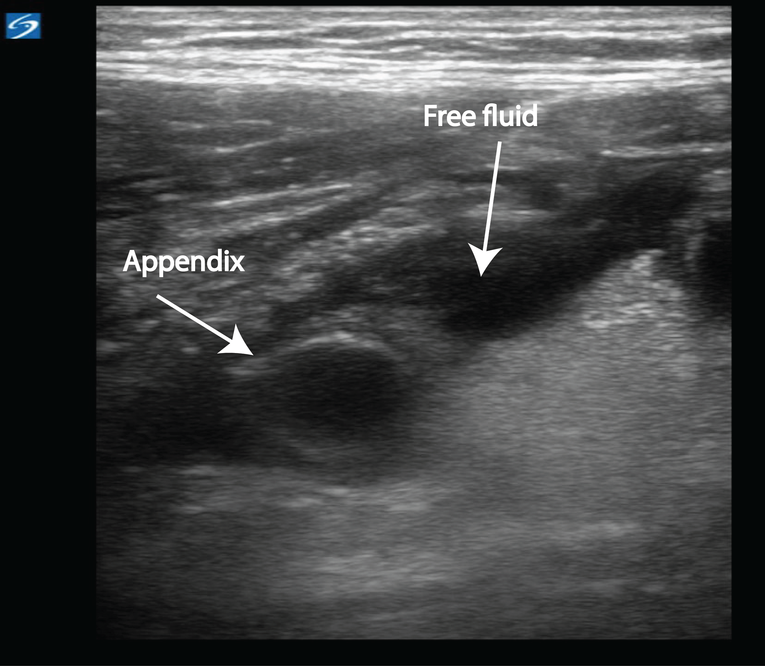 Appendicitis - Critical Care Sonography