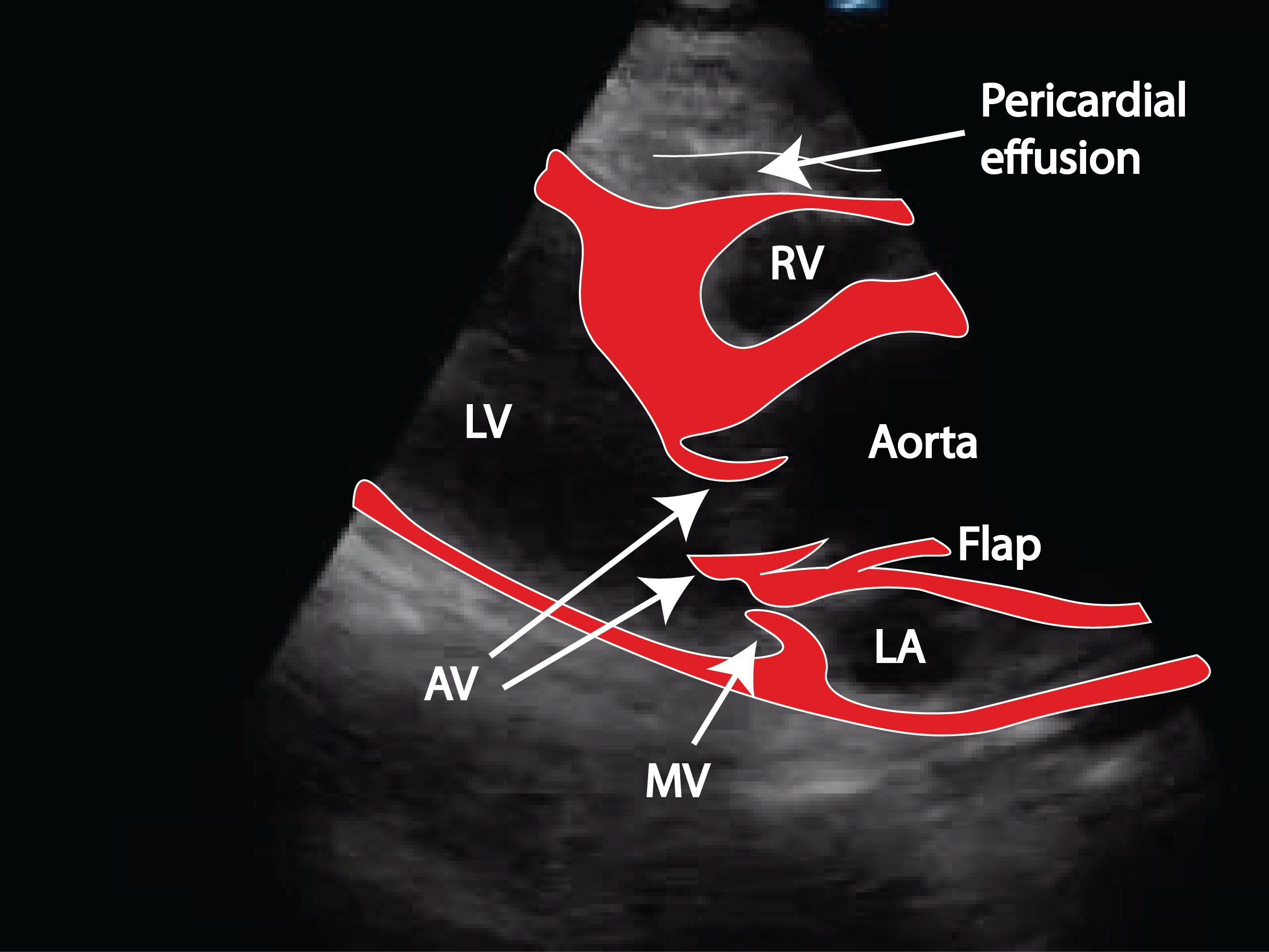 Type A dissection - Critical Care Sonography