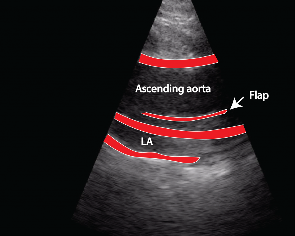 Type A dissection - Critical Care Sonography