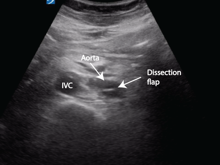 Type A dissection - Critical Care Sonography