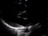ECHO : image optimisation - Critical Care Sonography