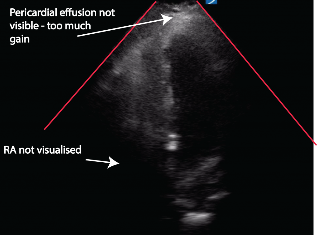 ECHO : image optimisation - Critical Care Sonography