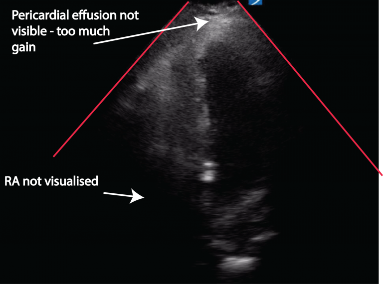 ECHO : image optimisation - Critical Care Sonography