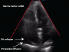ECHO : image optimisation - Critical Care Sonography