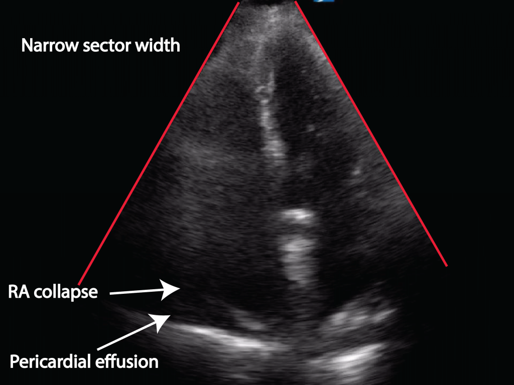 ECHO : image optimisation - Critical Care Sonography