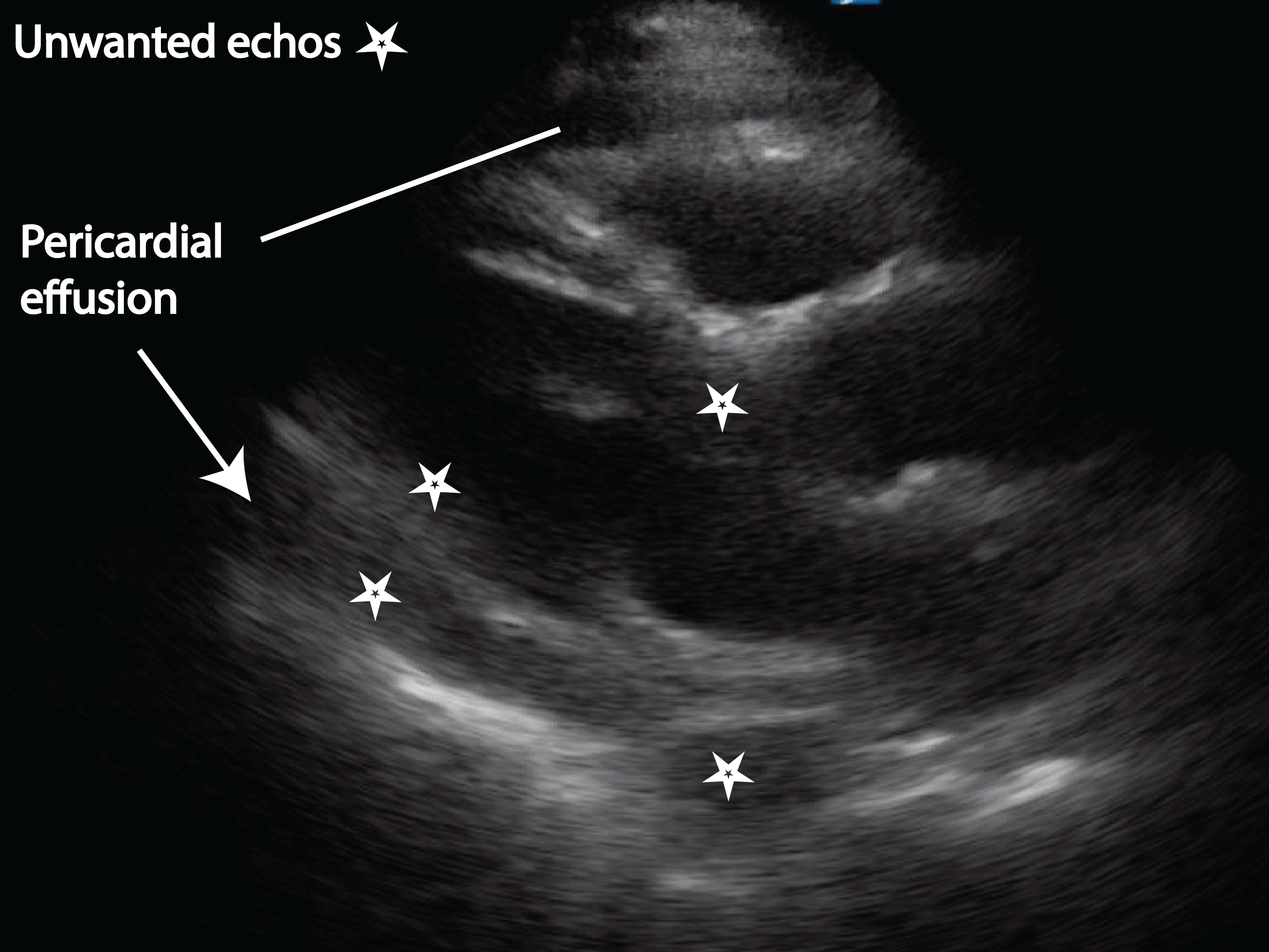 ECHO : image optimisation - Critical Care Sonography