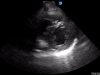 ECHO : image optimisation - Critical Care Sonography