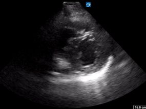 ECHO : image optimisation - Critical Care Sonography