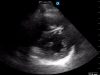 ECHO : image optimisation - Critical Care Sonography