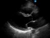 ECHO : image optimisation - Critical Care Sonography