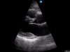 ECHO : image optimisation - Critical Care Sonography