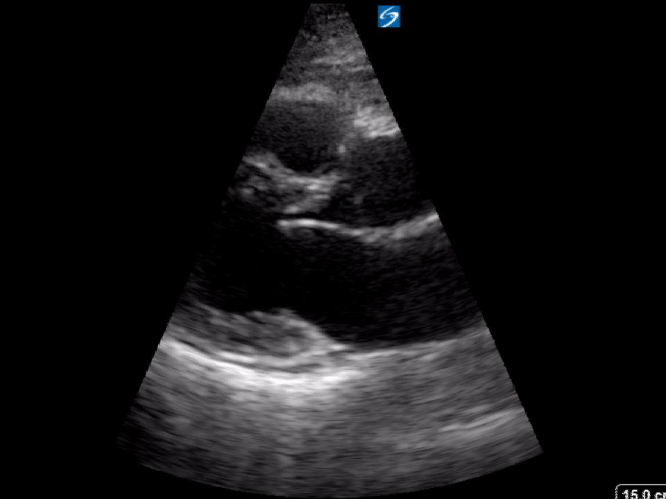 ECHO : image optimisation - Critical Care Sonography