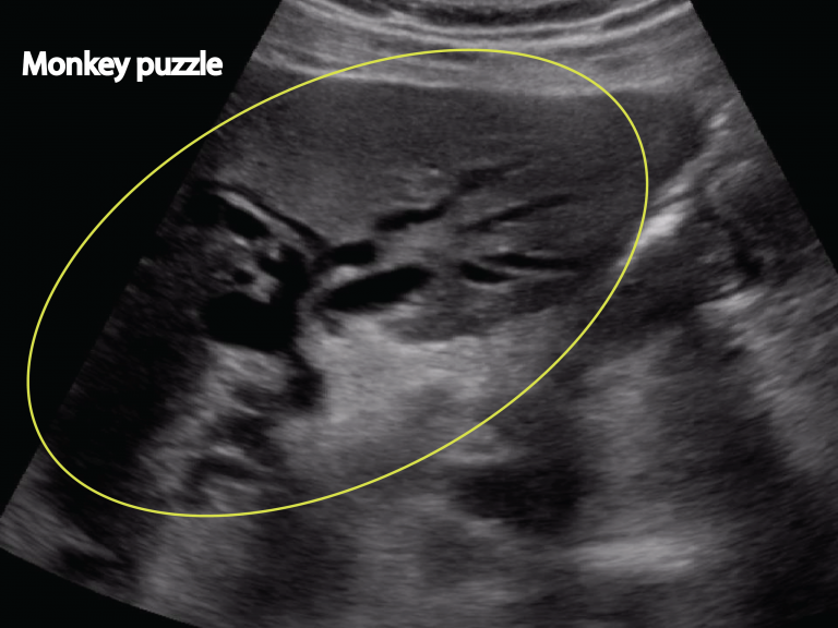 Biliary Obstruction: Double Barrel sign, Monkey Puzzle sign - Critical ...
