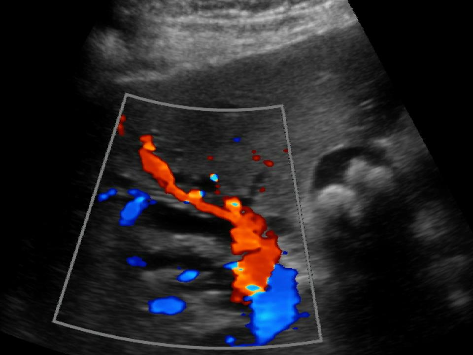 Biliary Obstruction: Double Barrel sign, Monkey Puzzle sign - Critical ...