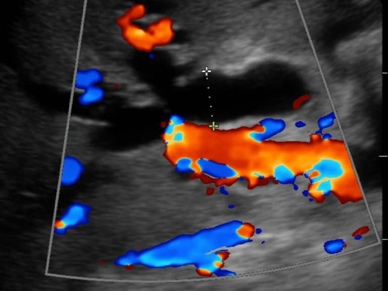 Biliary Obstruction: Double Barrel sign, Monkey Puzzle sign - Critical ...