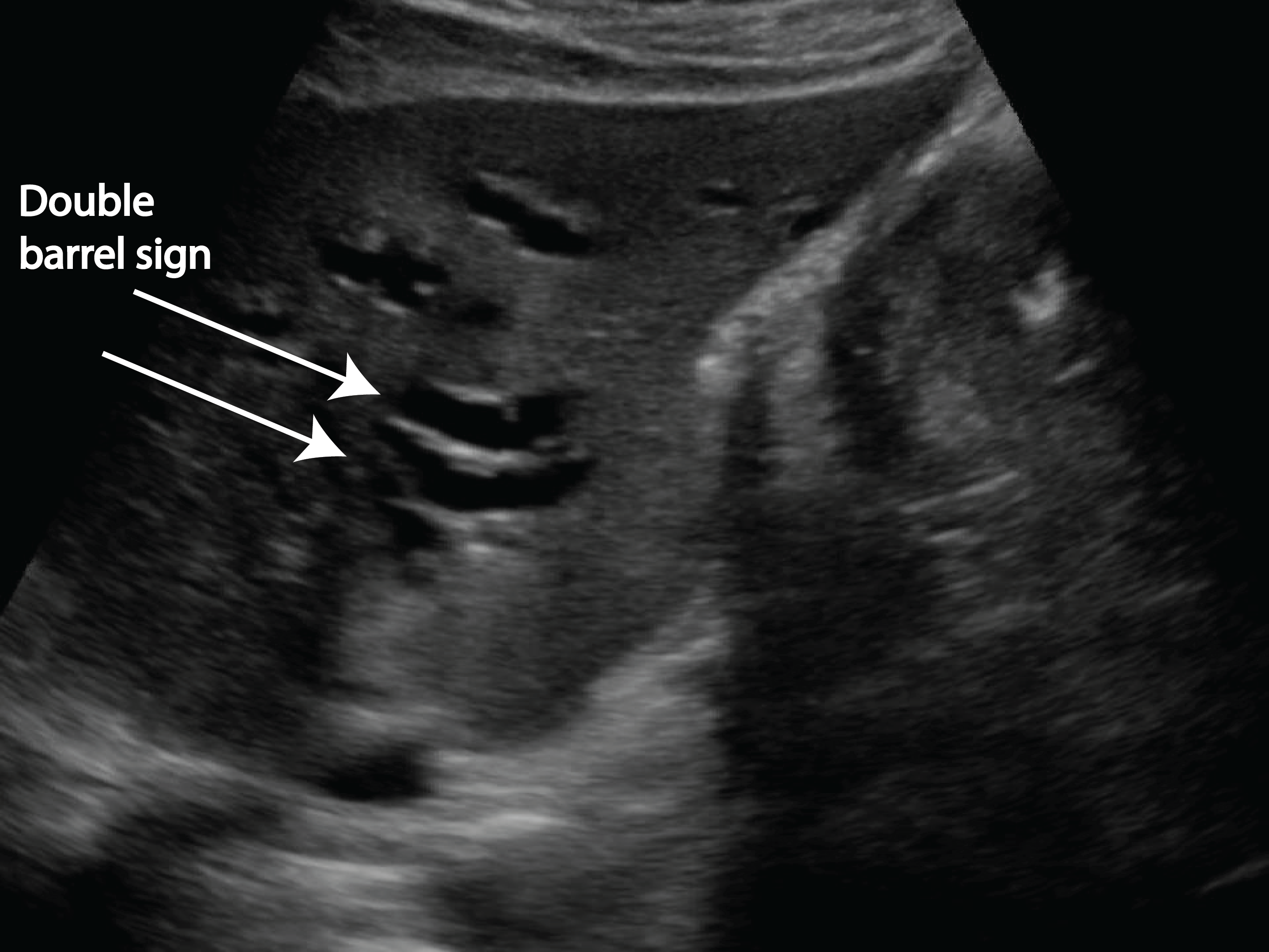 Biliary Obstruction: Double Barrel sign, Monkey Puzzle sign - Critical ...