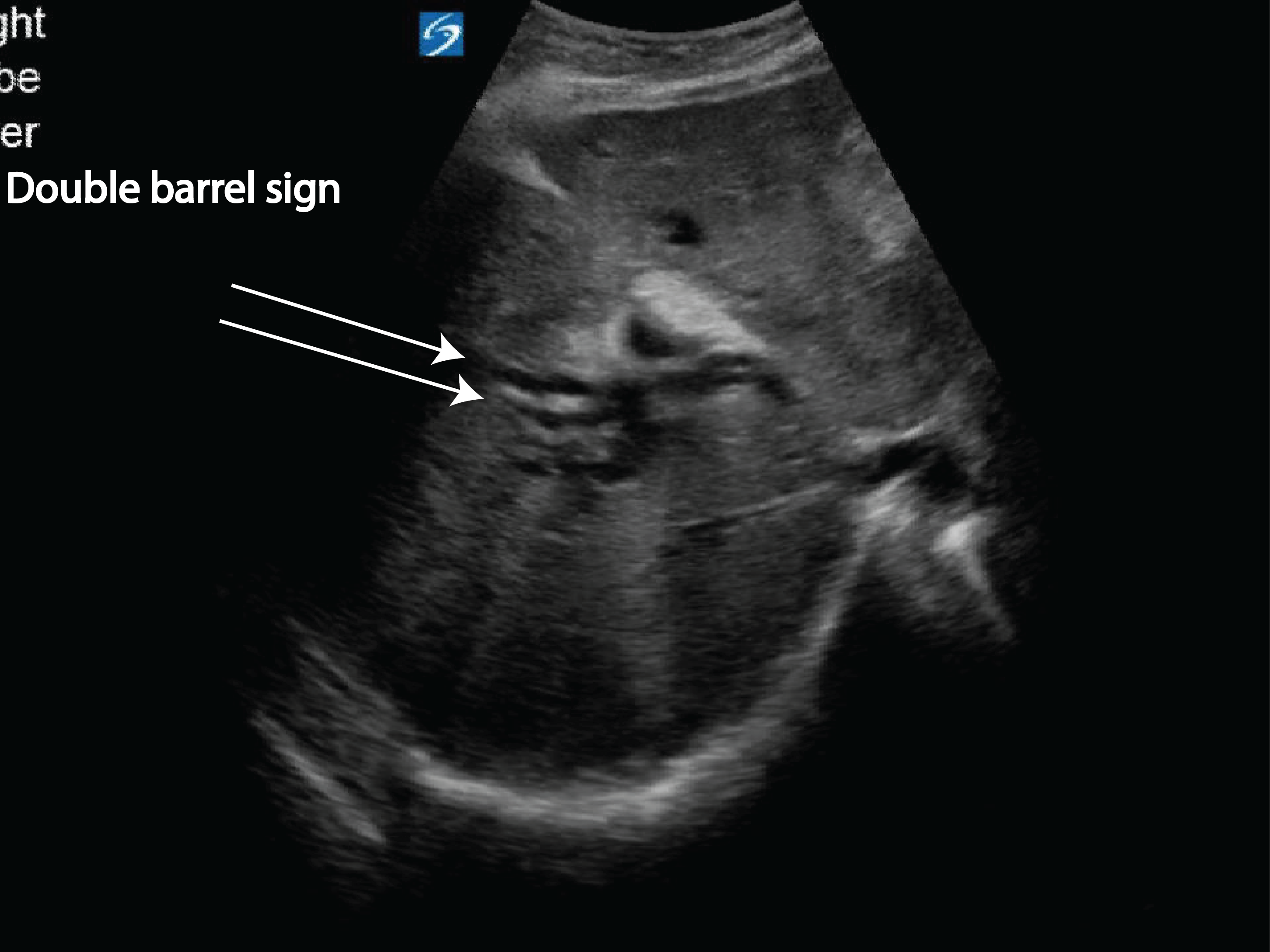 Biliary Obstruction: Double Barrel sign, Monkey Puzzle sign - Critical ...