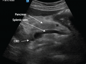 Biliary Obstruction: Double Barrel sign, Monkey Puzzle sign - Critical ...