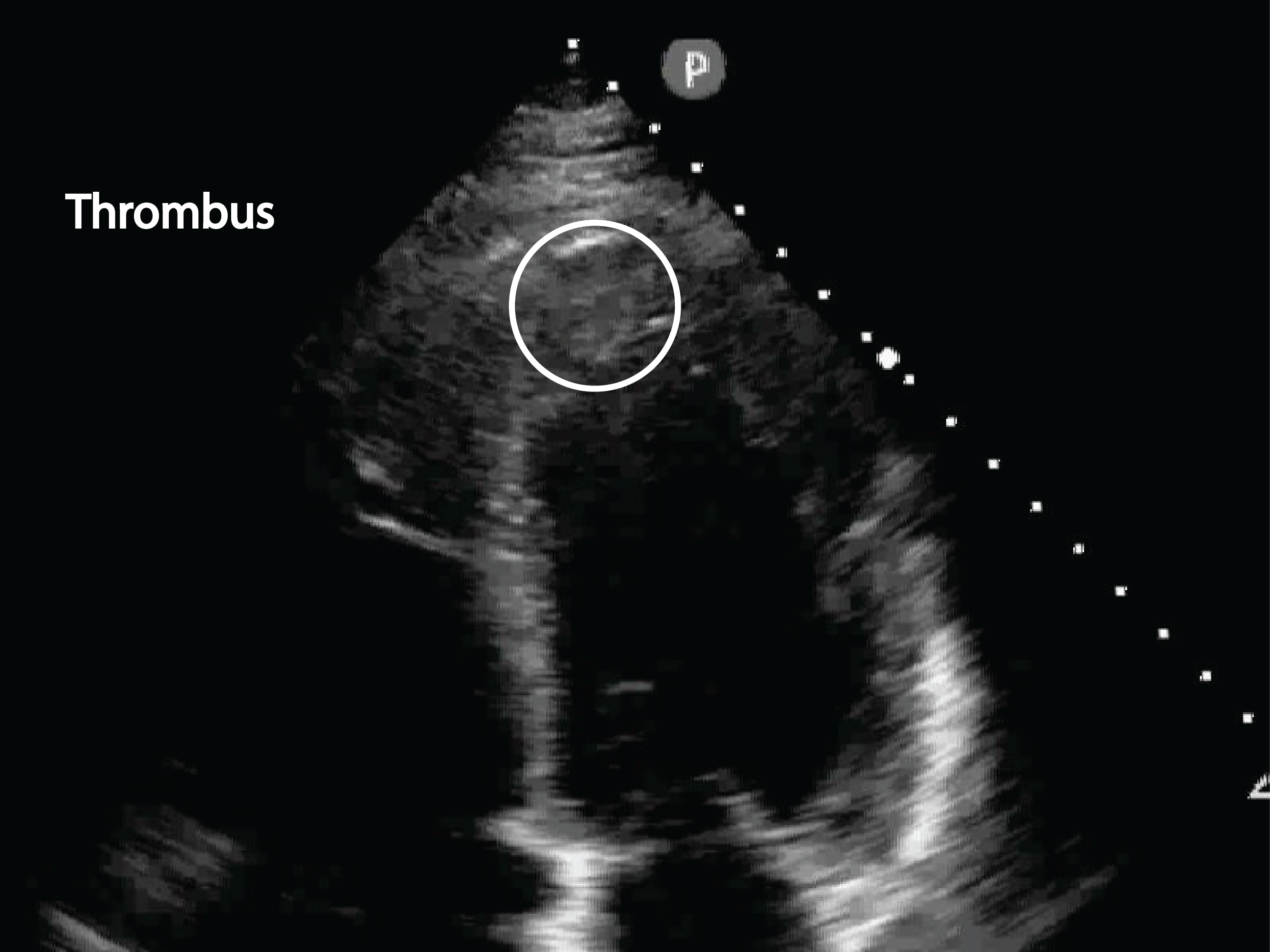 Ice cardiomyopathy, apical thrombus - Critical Care Sonography