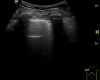 B lines - how best to see them - Critical Care Sonography