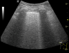 B lines - how best to see them - Critical Care Sonography