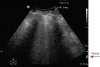 B lines - how best to see them - Critical Care Sonography