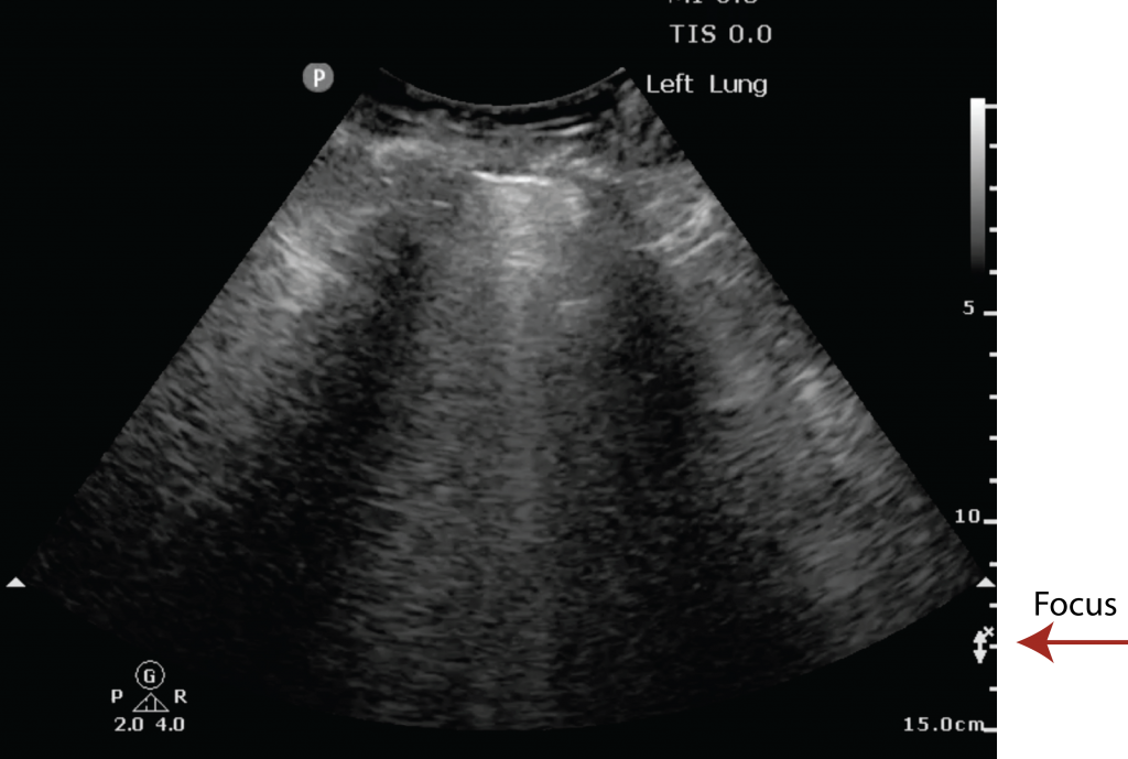 B lines - how best to see them - Critical Care Sonography