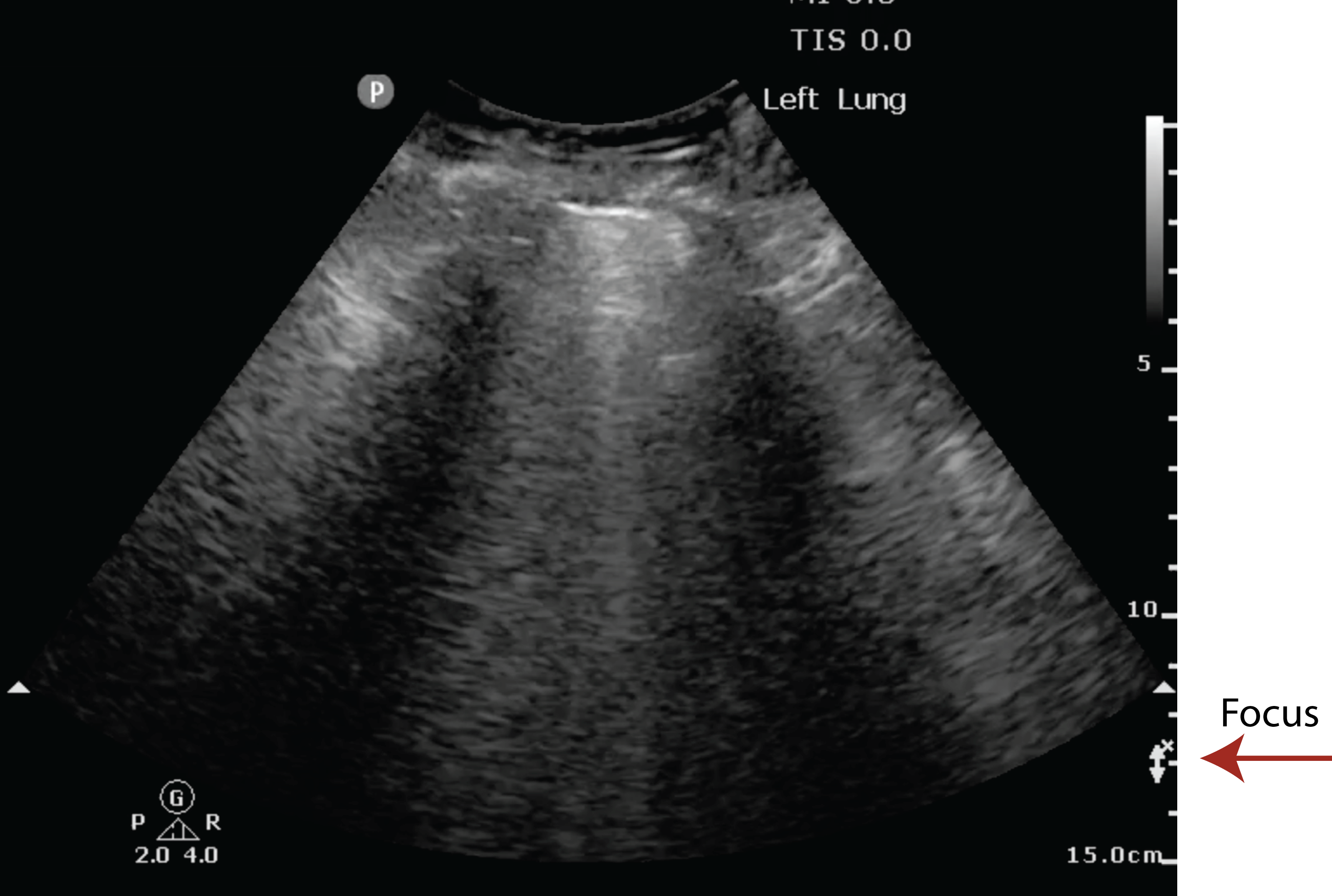 B lines - how best to see them - Critical Care Sonography
