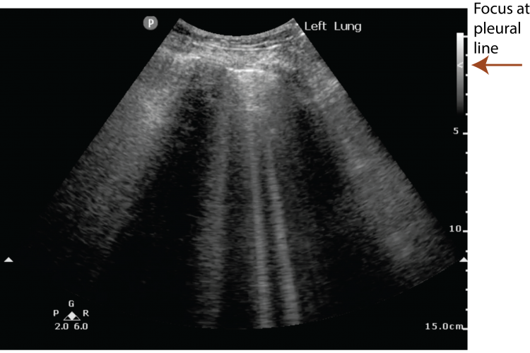 B lines - how best to see them - Critical Care Sonography