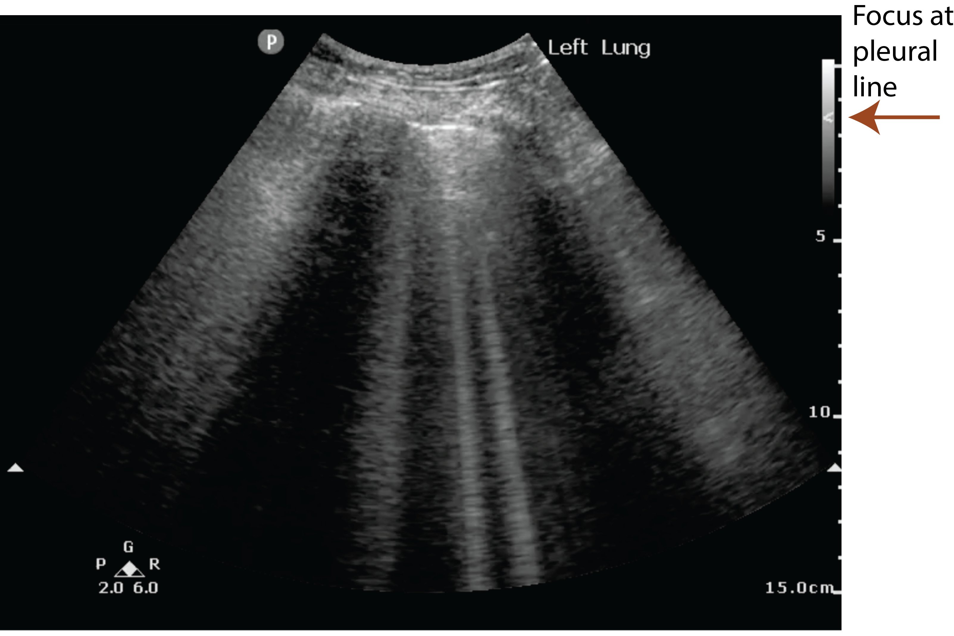 B lines - how best to see them - Critical Care Sonography
