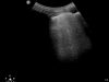 B lines - how best to see them - Critical Care Sonography