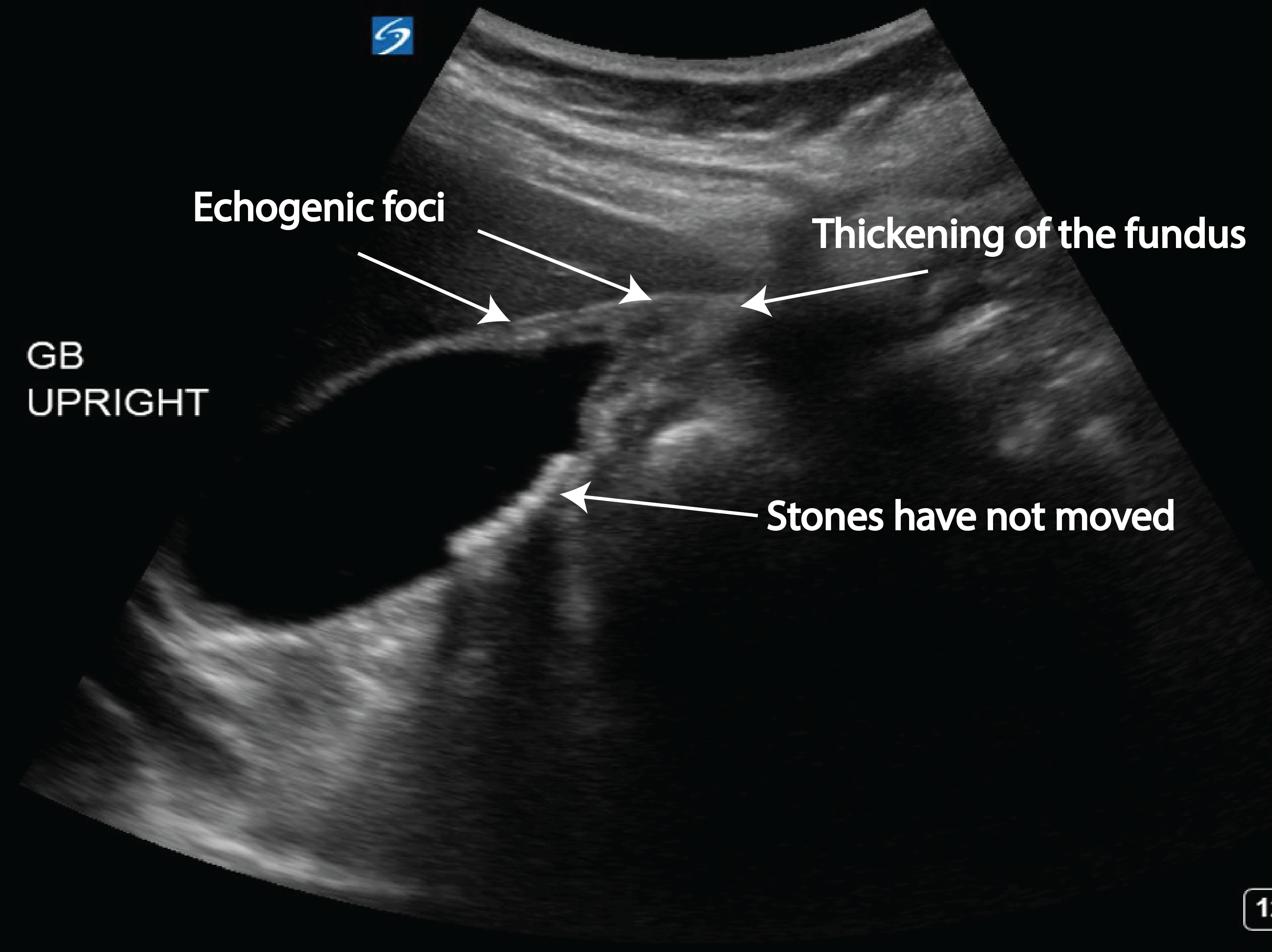 Pitfall - Stones in the gall bladder - Adenomyomatosis - Critical Care ...