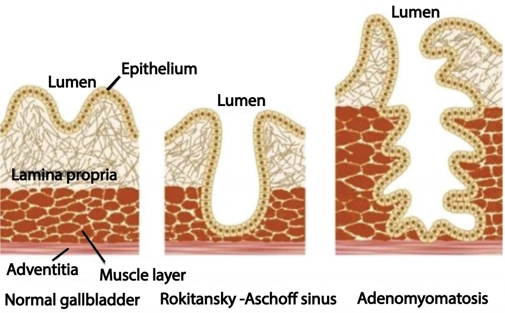 Pitfall - Stones in the gall bladder - Adenomyomatosis - Critical Care ...