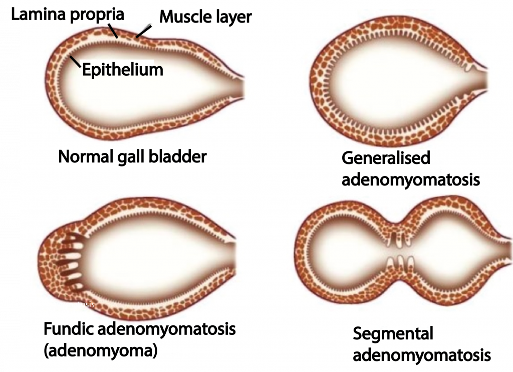 Gallbladder Adenomyomatosis Causes Symptoms Diagnosis