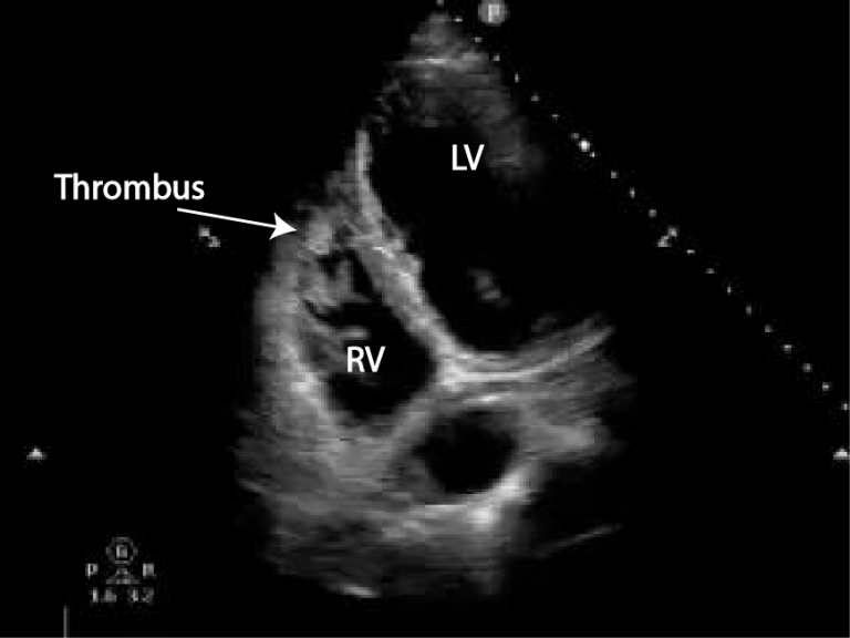 Right ventricular thrombus - Critical Care Sonography