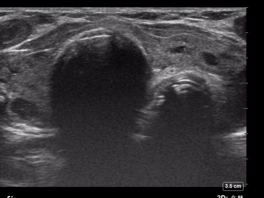 Oesophageal intubation : Double tract sign - Critical Care Sonography