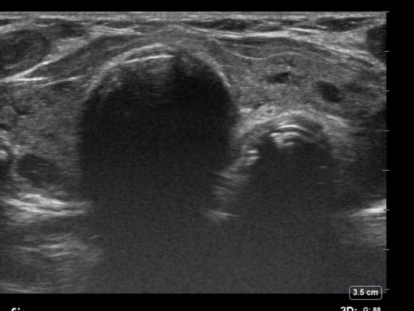 Oesophageal intubation : Double tract sign - Critical Care Sonography