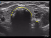 Oesophageal intubation : Double tract sign - Critical Care Sonography