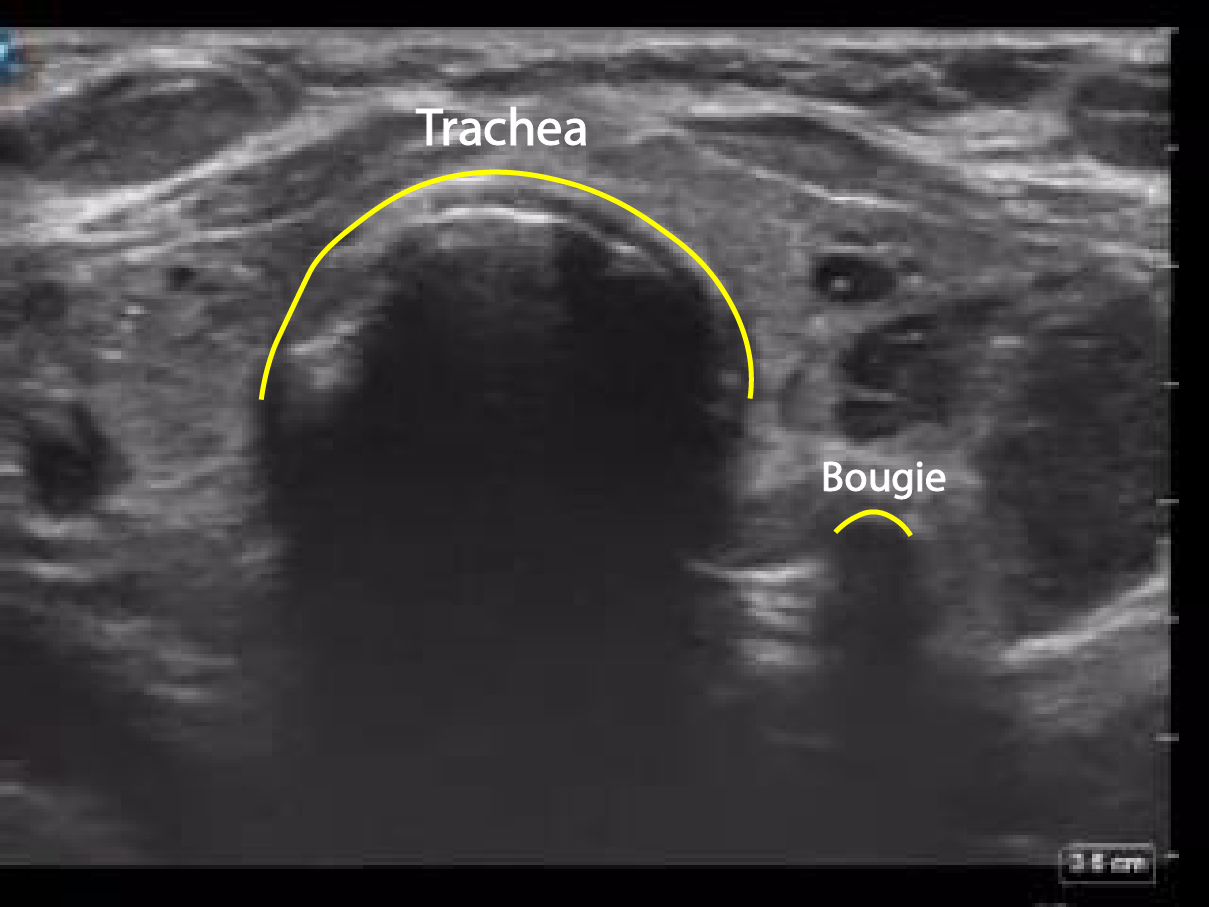 Oesophageal intubation : Double tract sign - Critical Care Sonography