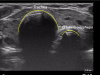 Oesophageal intubation : Double tract sign - Critical Care Sonography
