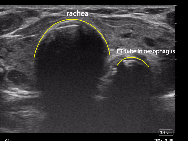 Oesophageal intubation : Double tract sign - Critical Care Sonography